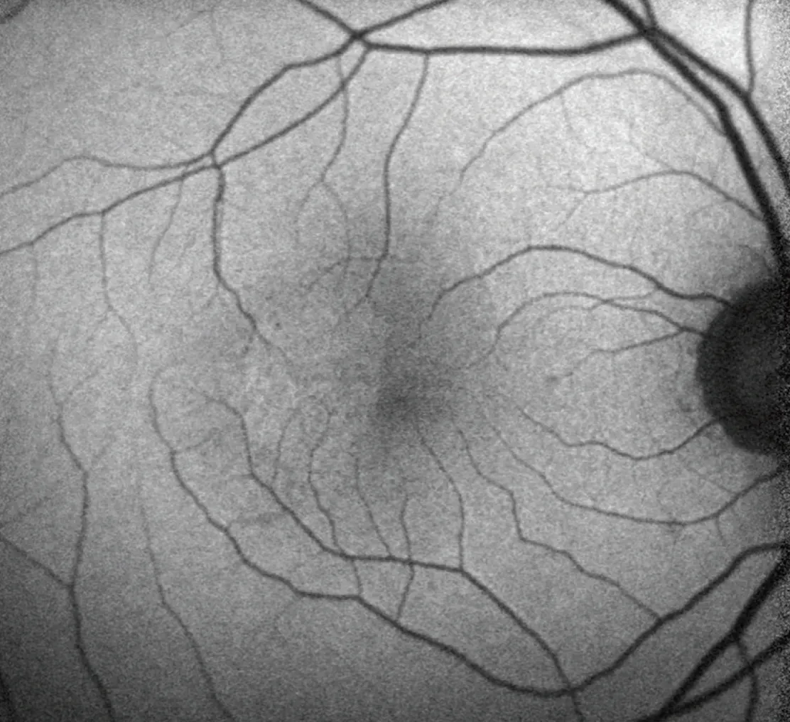Diagnostic Pearls for MacTel Type 2 - Retina Today