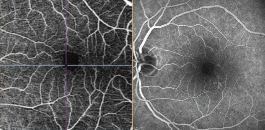 Diagnostic Pearls for MacTel Type 2 - Retina Today