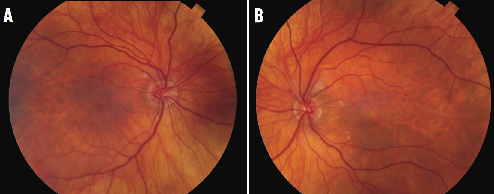 Watch for Choroidal Detachments in Cryptococcosis - Retina Today