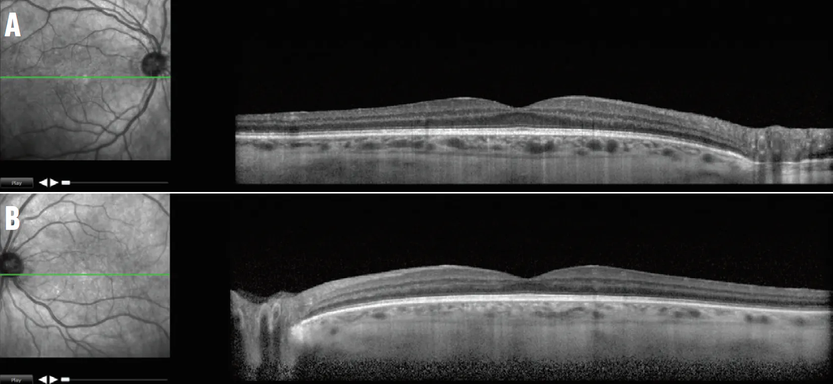 Watch for Choroidal Detachments in Cryptococcosis - Retina Today