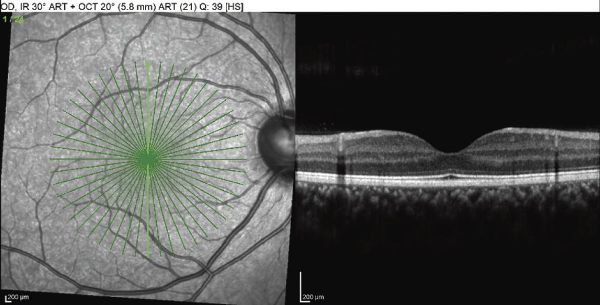 Commotio Retinae in a Teenager - Modern Optometry