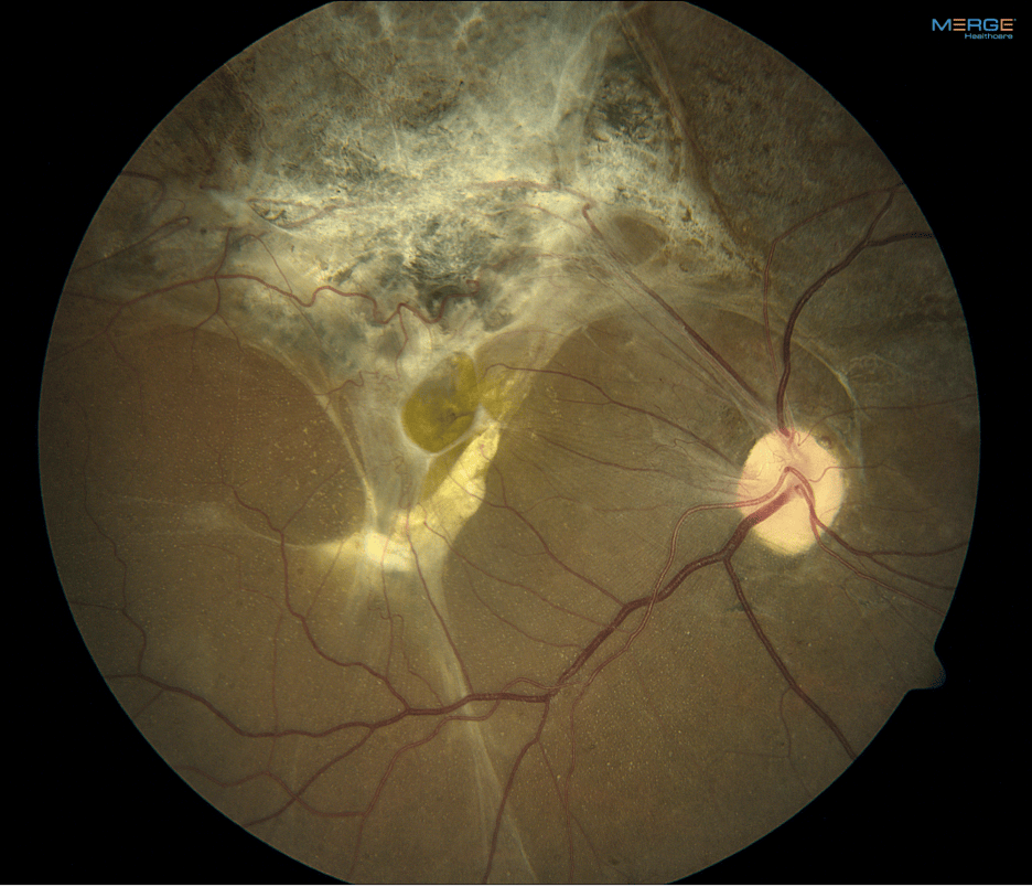 How To Handle Traumatic Retinal Detachments - Retina Today