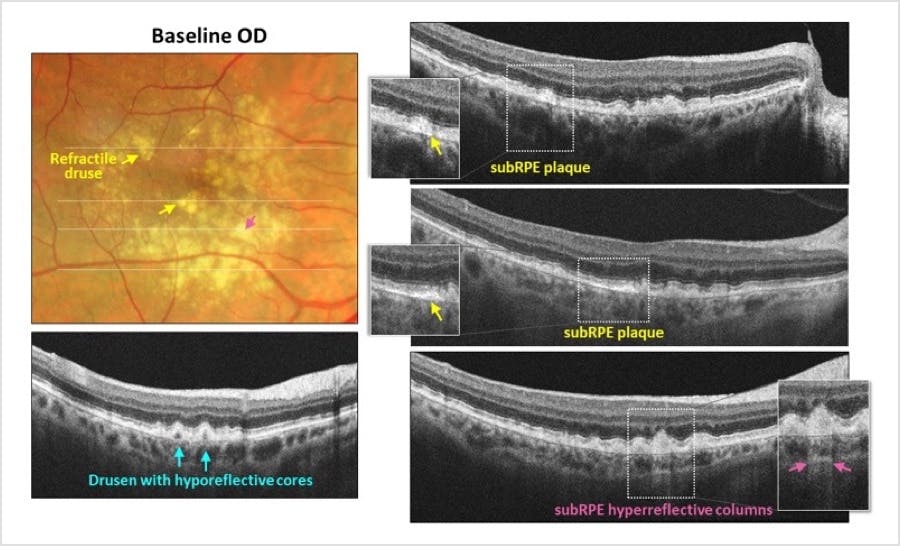 GA Case Compendium: Identifying High-Risk Biomarkers for Geographic ...