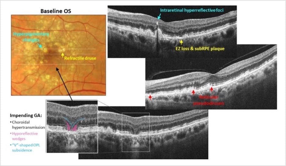 GA Case Compendium: Identifying High-Risk Biomarkers for Geographic ...