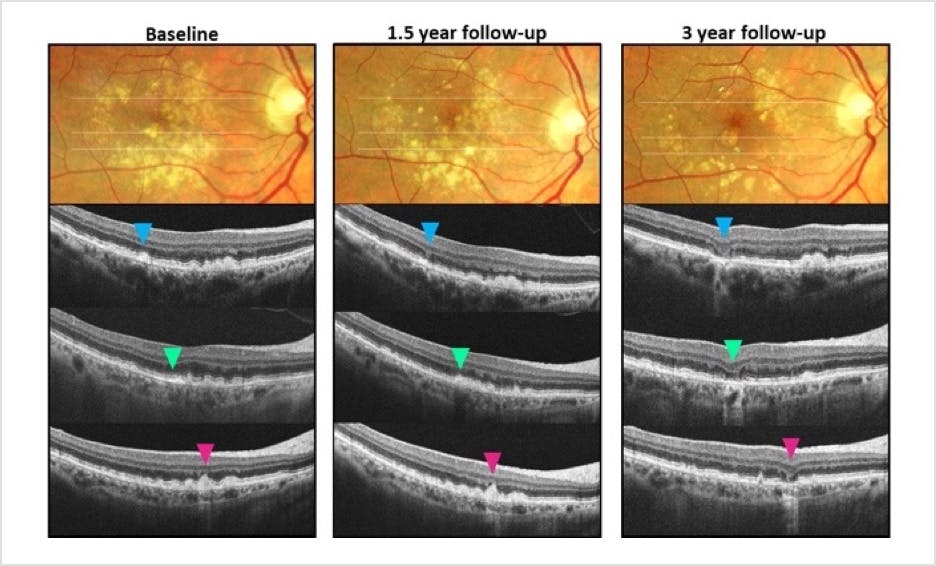 GA Case Compendium: Identifying High-Risk Biomarkers for Geographic ...