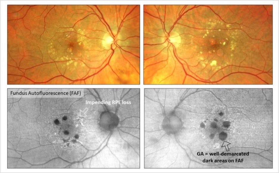GA Case Compendium: Identifying High-Risk Biomarkers for Geographic ...