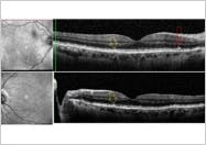 GA Case Compendium: Simultaneous Development of Geographic Atrophy and ...