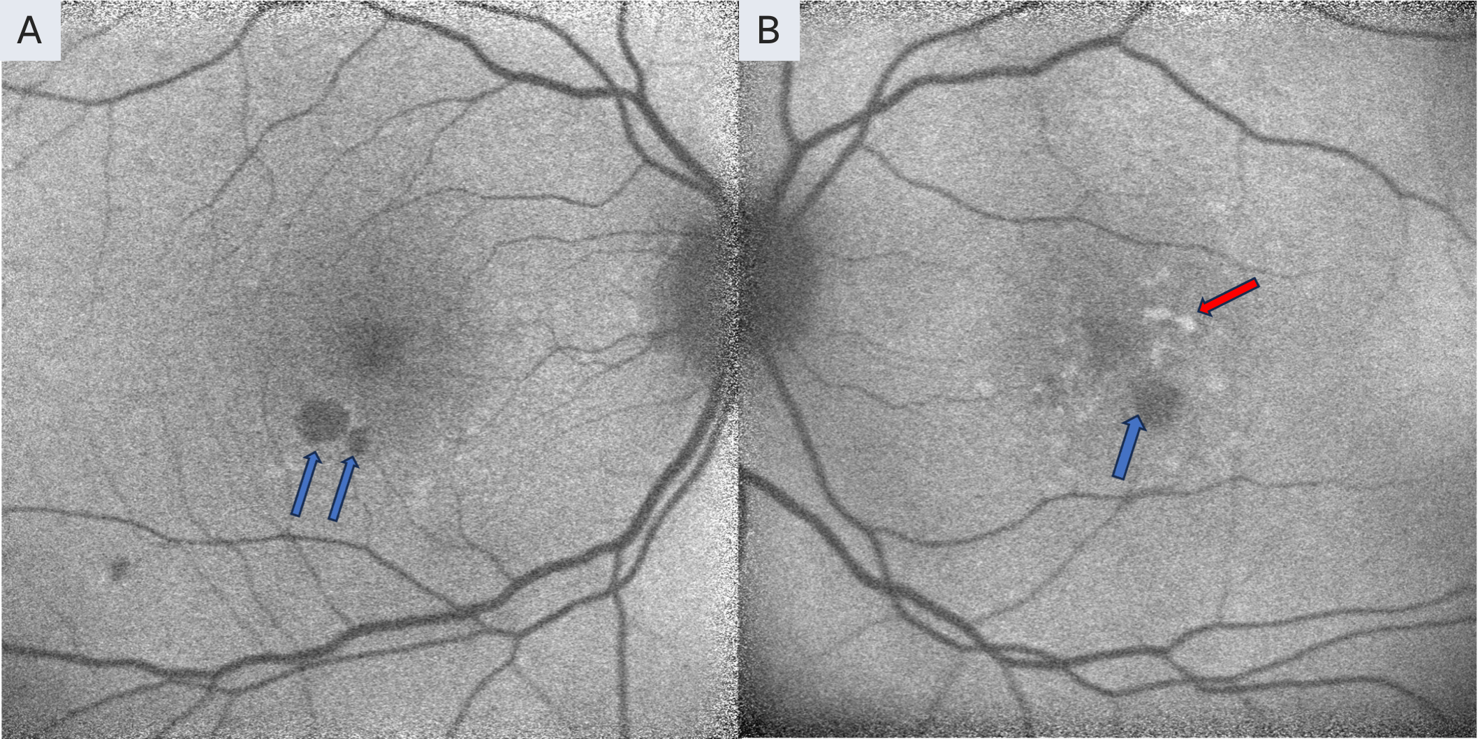 GA Case Compendium: Rapid Loss of Vision Associated With Geographic ...