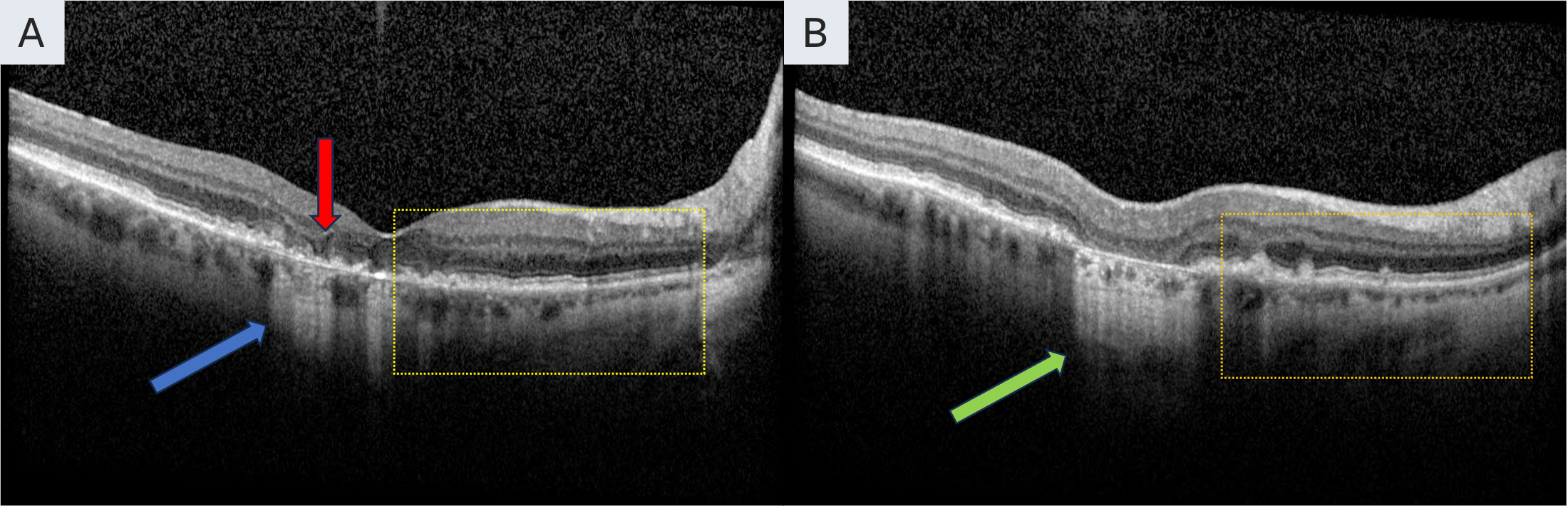 GA Case Compendium: Rapid Loss of Vision Associated With Geographic ...