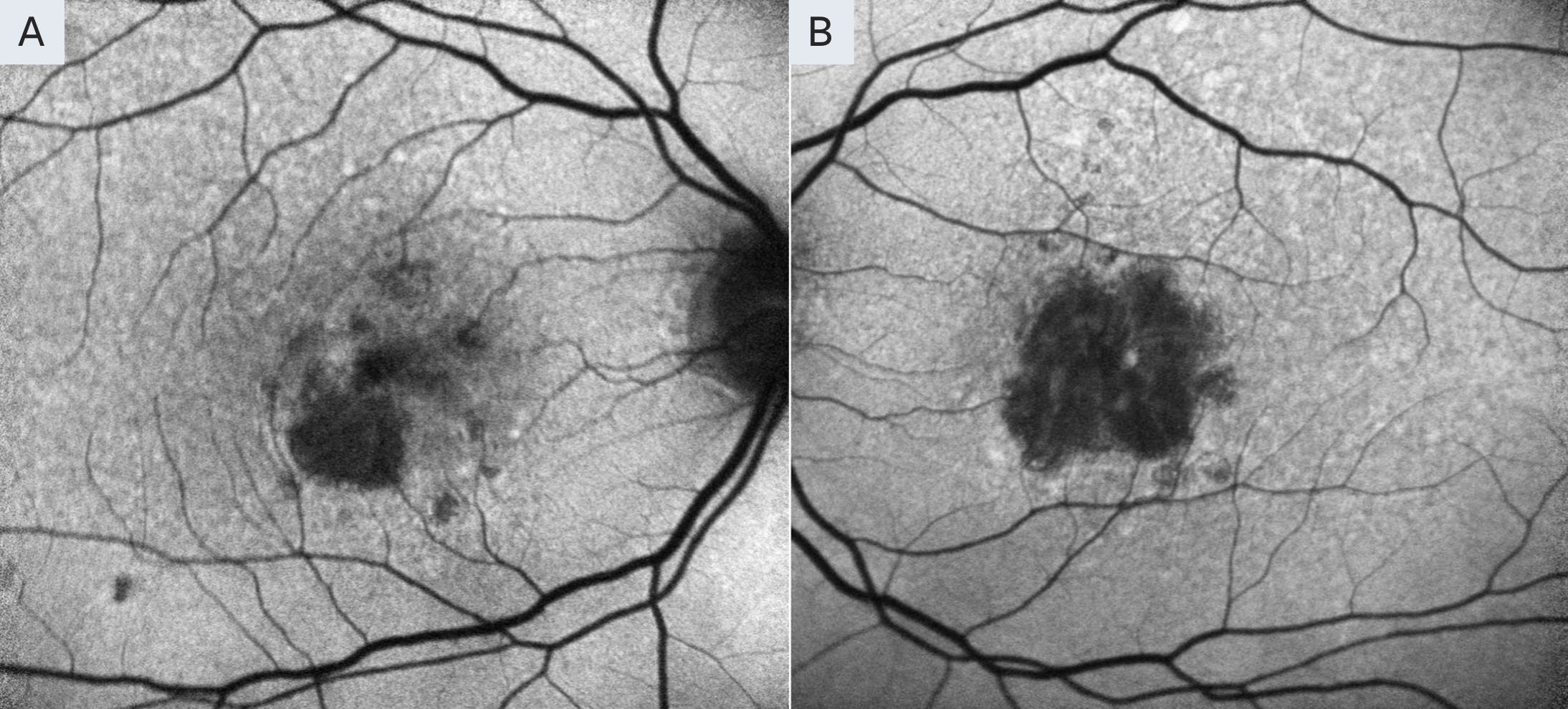 GA Case Compendium: Rapid Loss of Vision Associated With Geographic ...
