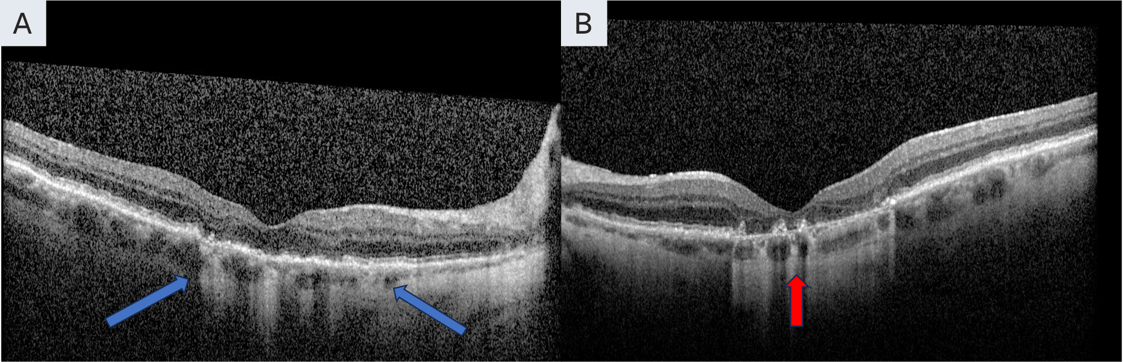 GA Case Compendium: Rapid Loss of Vision Associated With Geographic ...