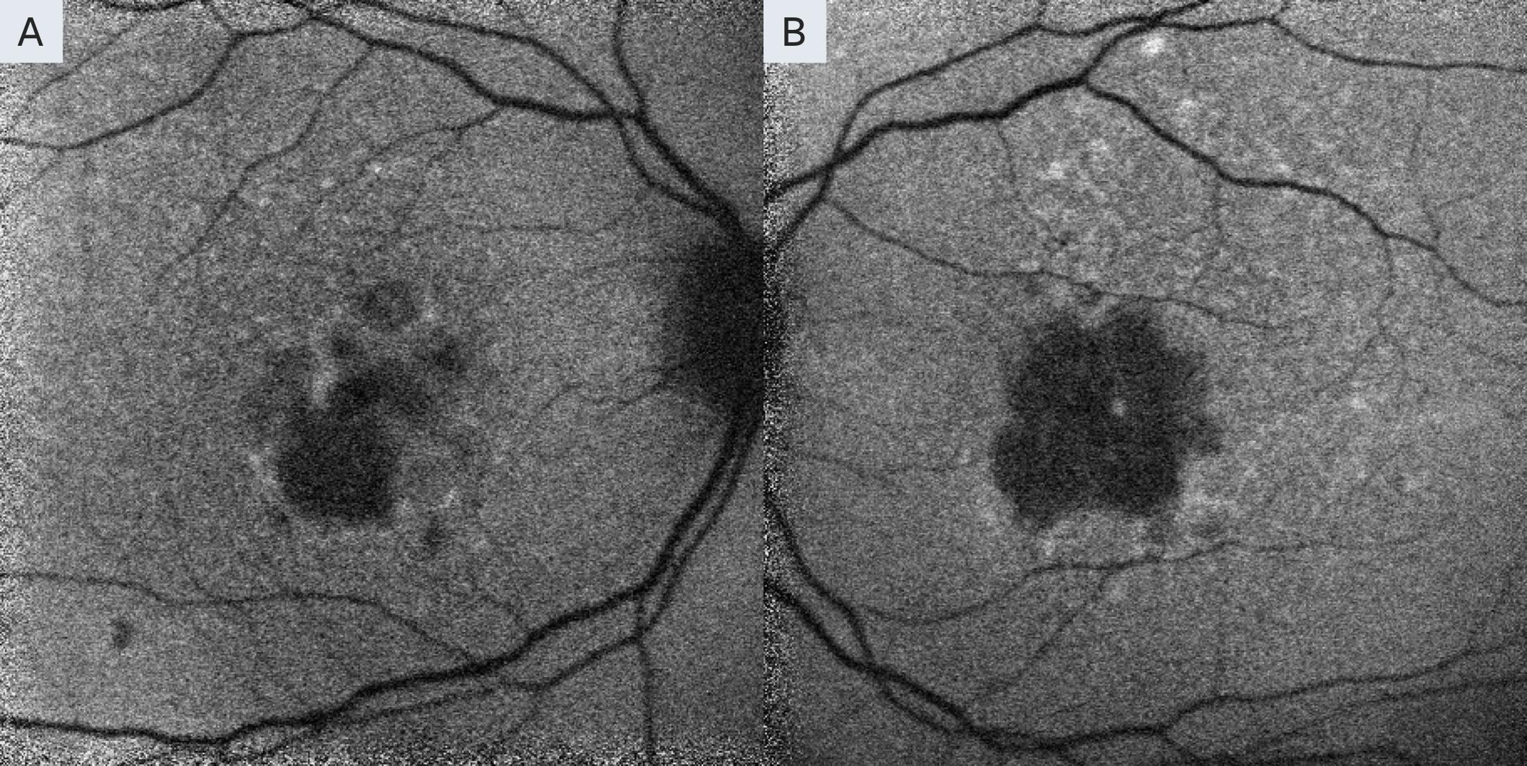 GA Case Compendium: Rapid Loss of Vision Associated With Geographic ...