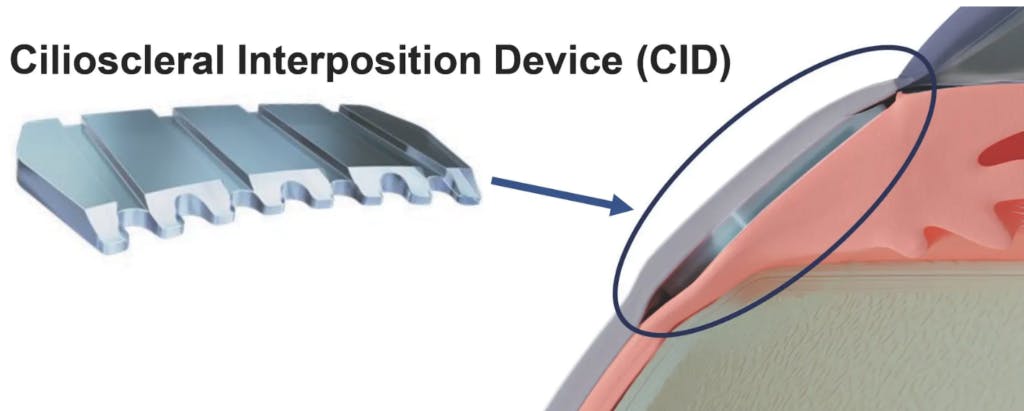 Ciliatech Releases New Design of Glaucoma Surgical Device CID - Eyewire+