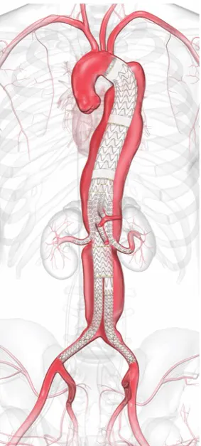 Gore Introduces Excluder TAMBE Device in Europe - Endovascular Today