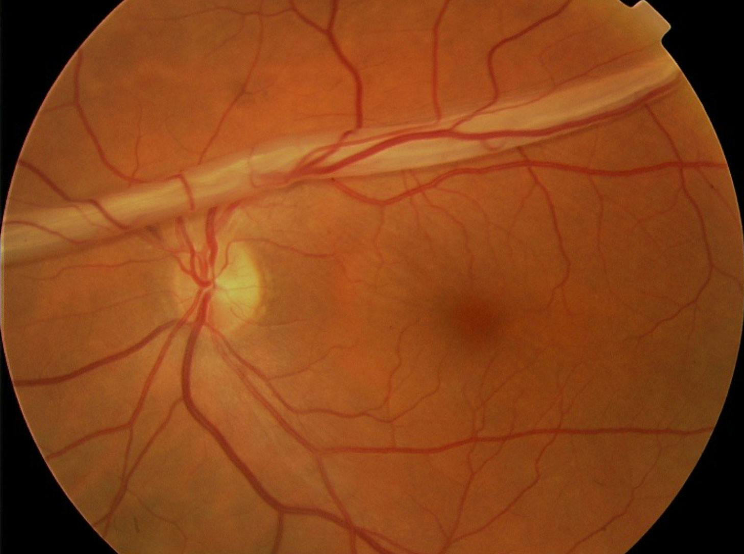 RD Repair: Slow and Steady Wins the Race - Retina Today