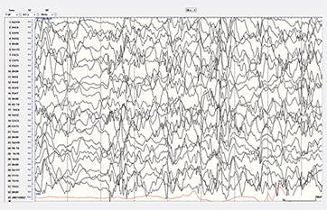 Epilepsy EssentialsInfantile Spasms: The Biggest Little Seizures ...