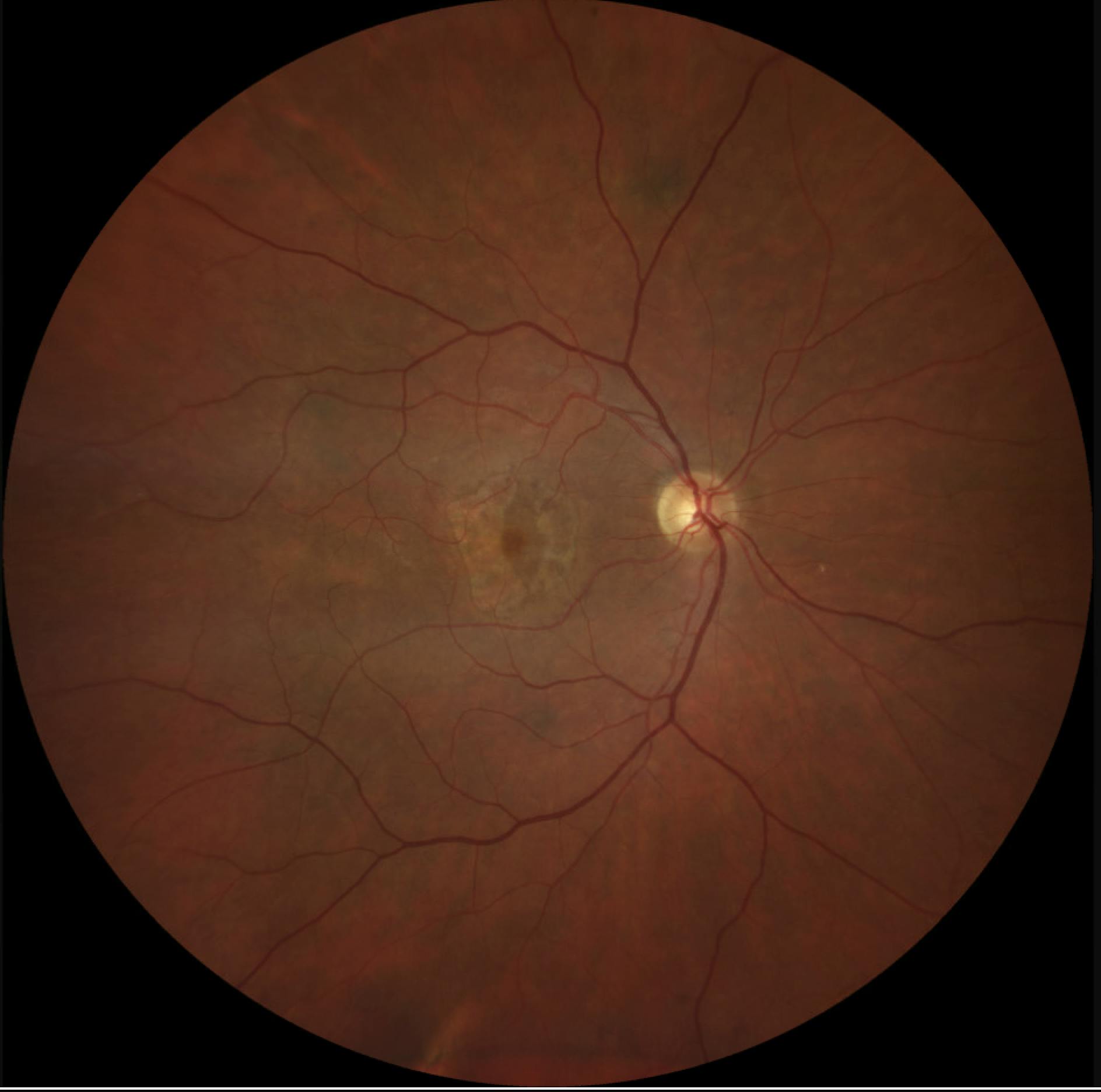 Trials and Innovations in Geographic Atrophy Therapy - Retina Today