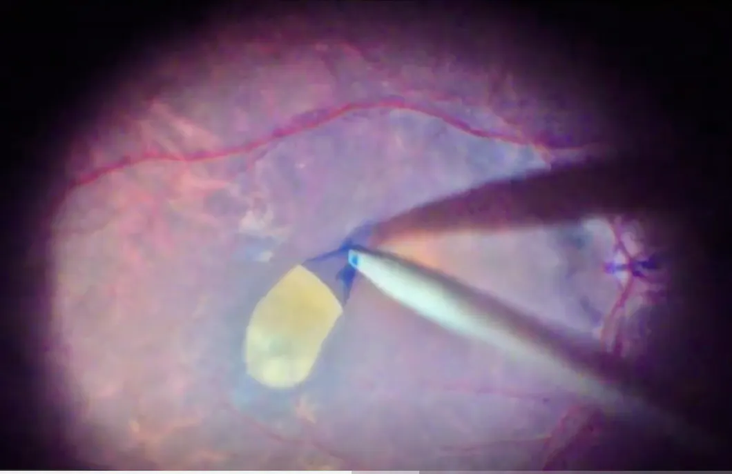 ILM Tear-and-Lift Technique for Macular Holes With Nonexpansive SF6 Gas ...