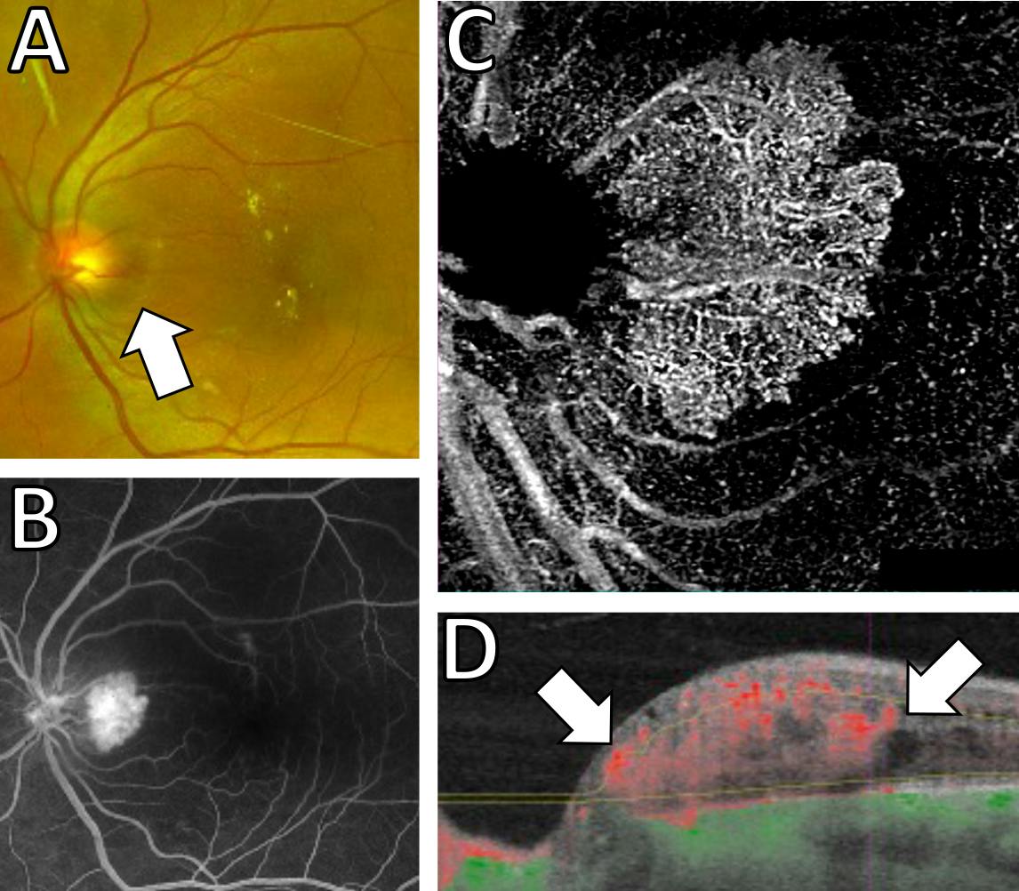 Diagnosing Exophytic Retinal Capillary Hemangioblastoma - Retina Today