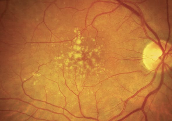 Intermediate AMD Identified: Now What? - Modern Optometry