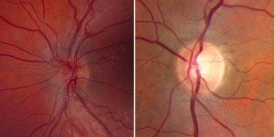 NIH: Gene Therapy for Rare Eye Disease Safe But Lacks Efficacy in Early ...