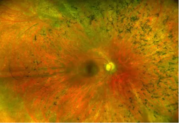 Retinitis Pigmentosa Retina Image Bank