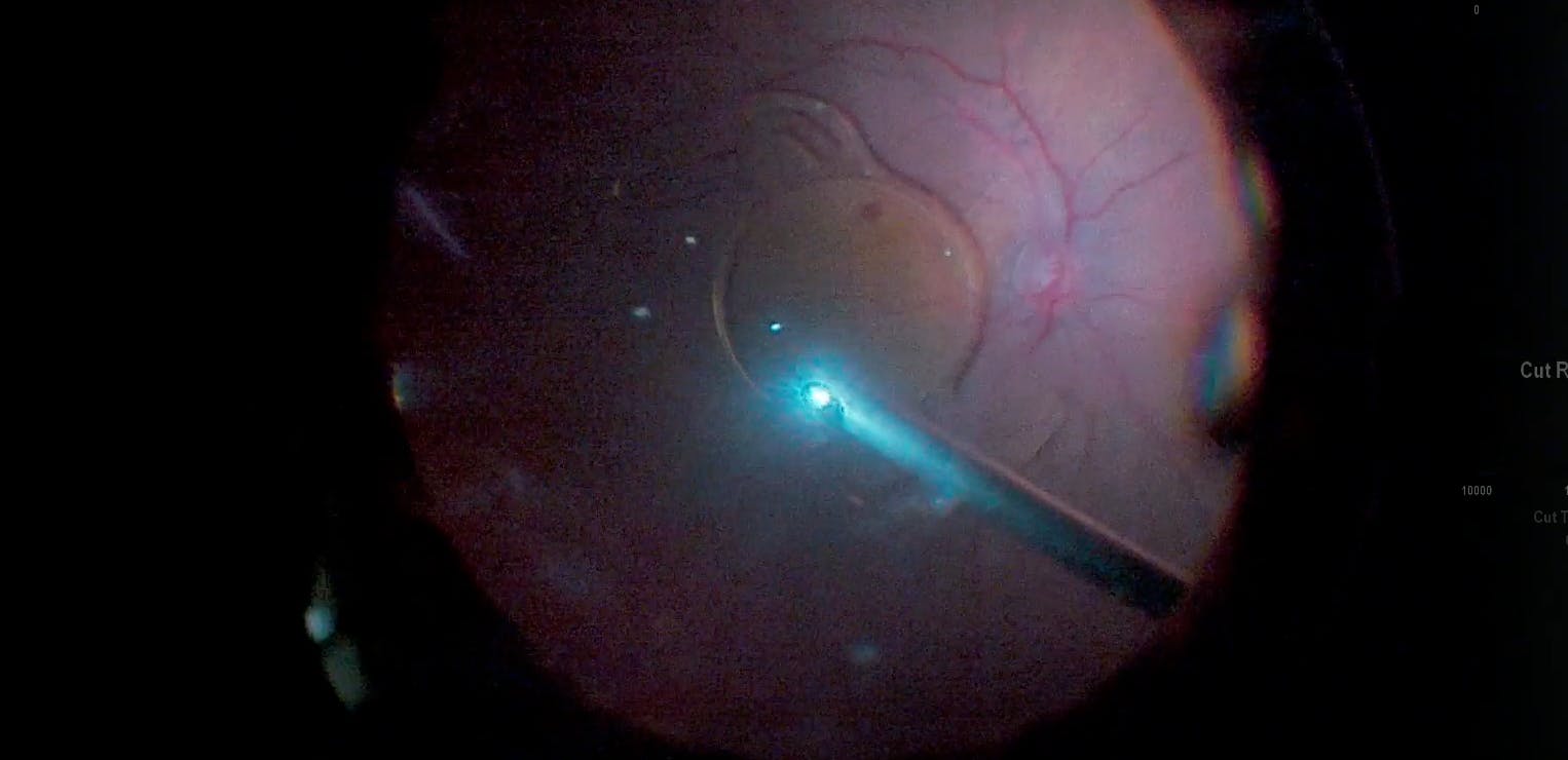 Removal of PCIOL on the Macula - Eyetube