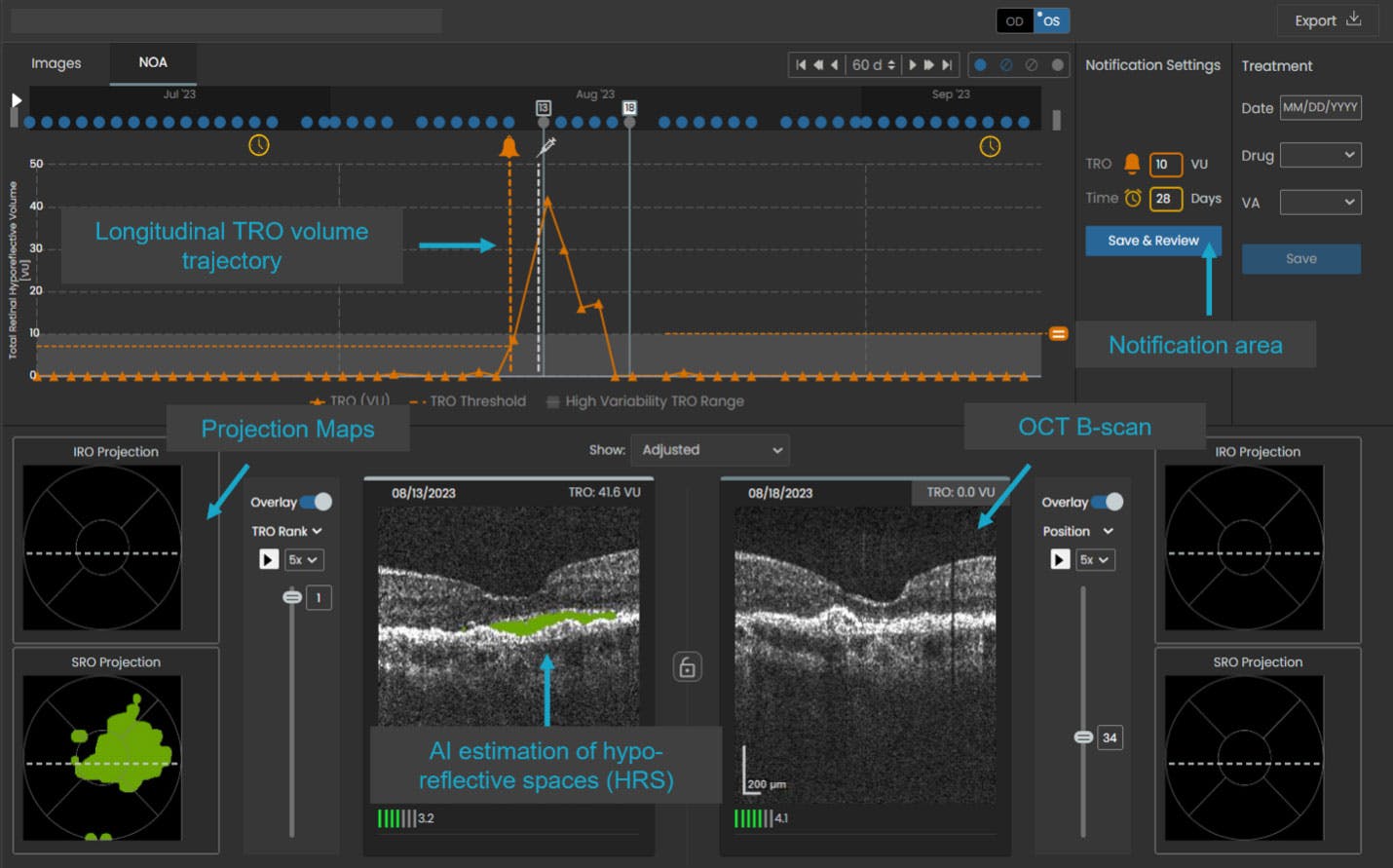 Home OCT: A Path Toward Remote Retinal Care - Retina Today
