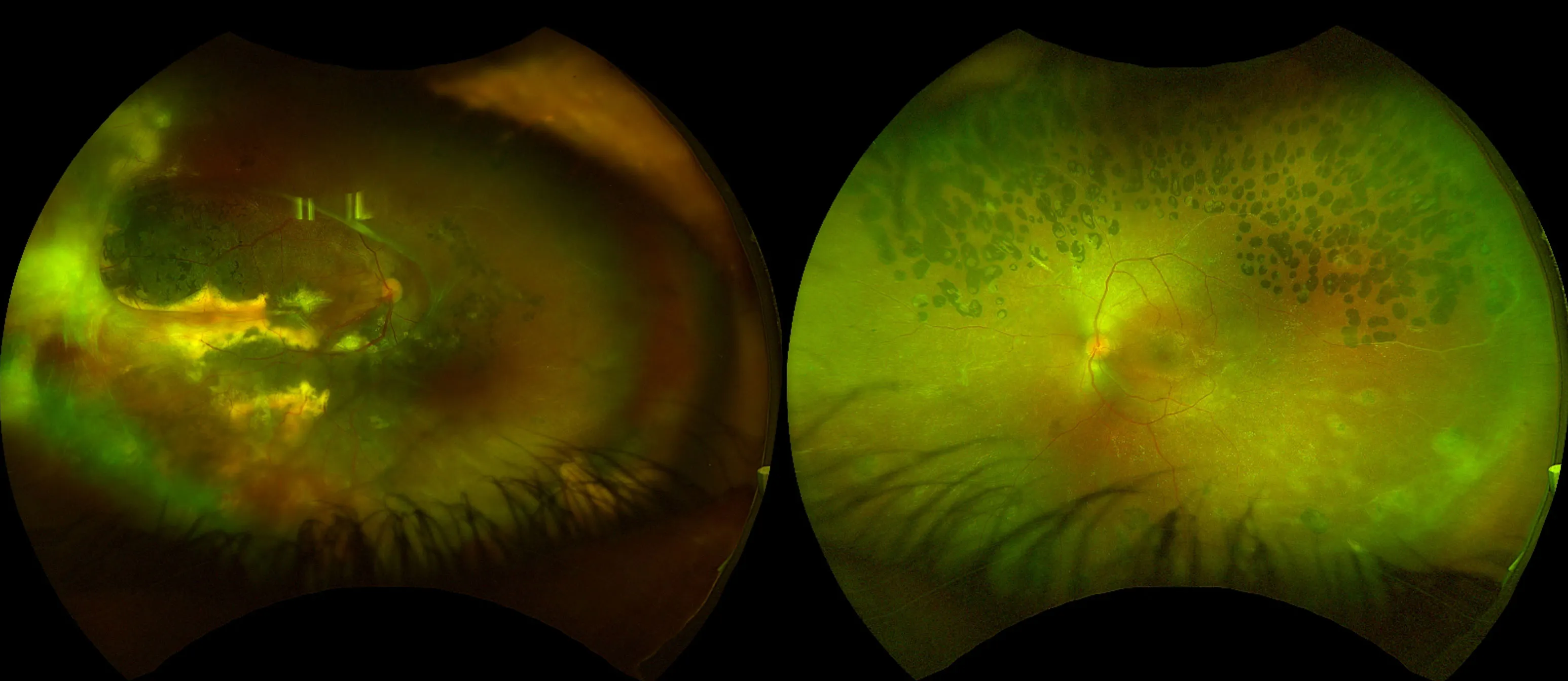 Test Your Diagnostic Acumen: IRD Mystery Cases - Retina Today