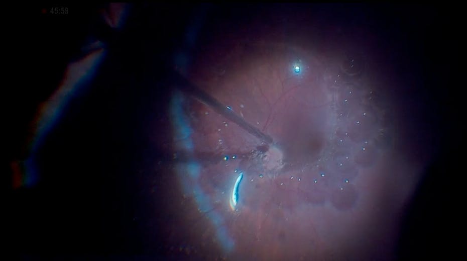 Minimally Invasive Vitrectomy for Phakic Retinal Detachment With ...