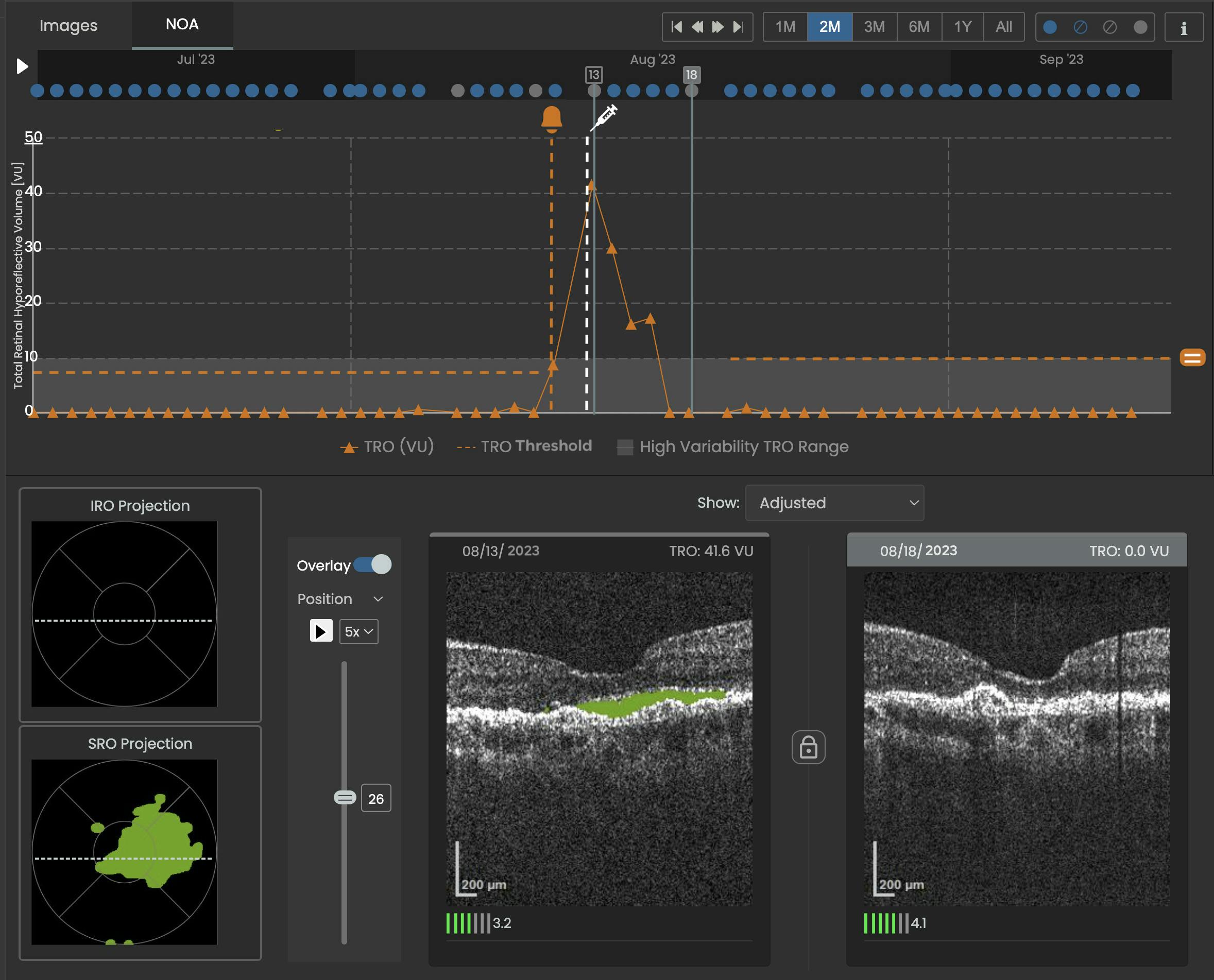 Study Examines AI-Driven Home OCT for Tracking Wet AMD Disease Activity ...
