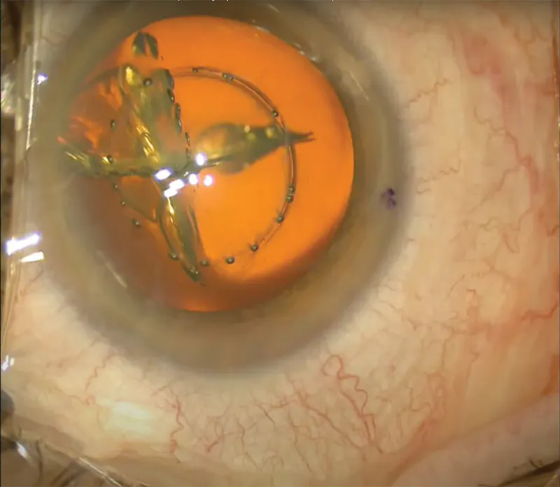 Canaloplasty: How it Works and Where it Fits in the MIGS Armamentarium ...