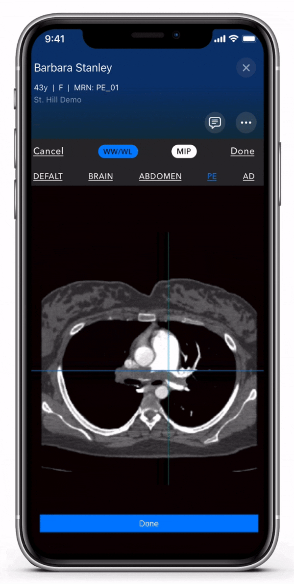 Viz.ai Launches AI-Powered Modules for Pulmonary Embolism and Aortic ...