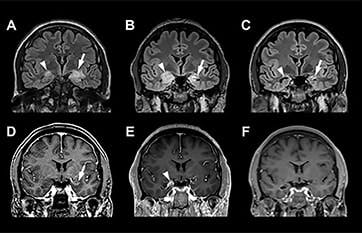 Autoimmune-Associated Epilepsy - Practical Neurology