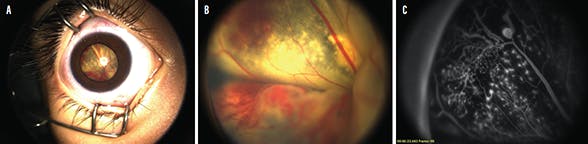 Updates in Pediatric Retinal Imaging - Retina Today