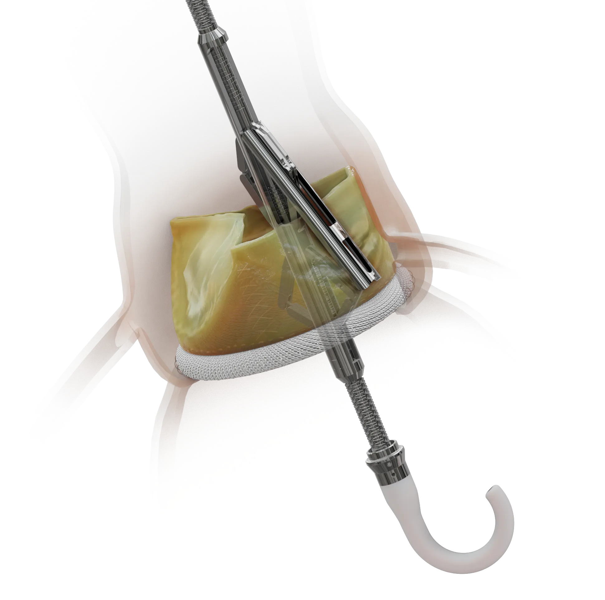 Pi-Cardia’s ShortCut Leaflet Modification Device for TAVR Used in First ...