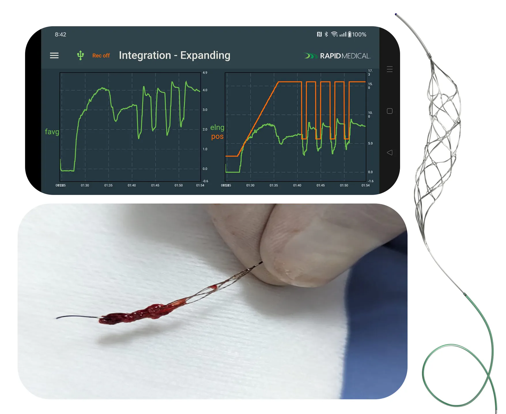 Rapid Medical’s Robotic Tigertriever Used in FIH Procedures to Treat ...