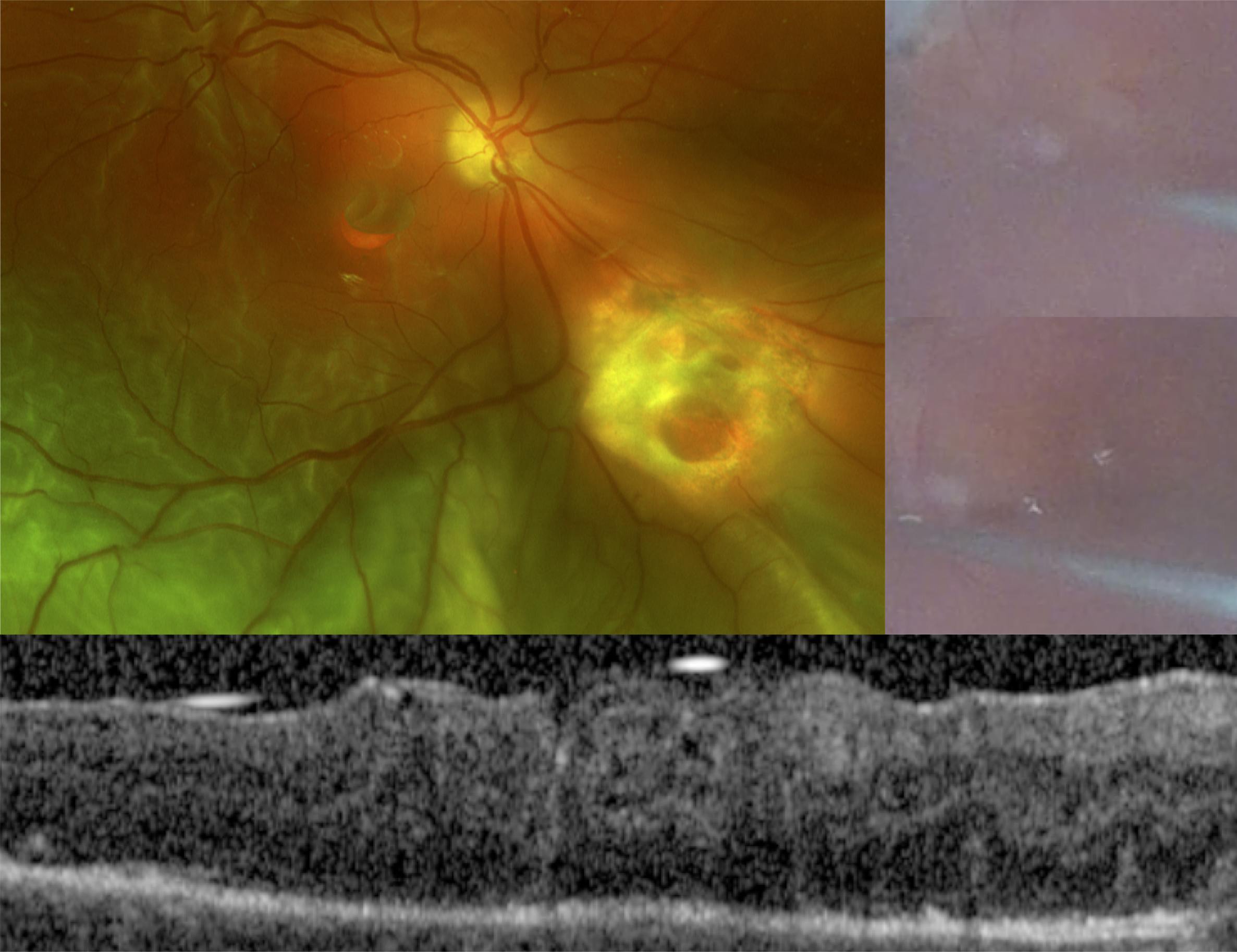 Tips for Successful Autologous Retinal Transplantation - Retina Today