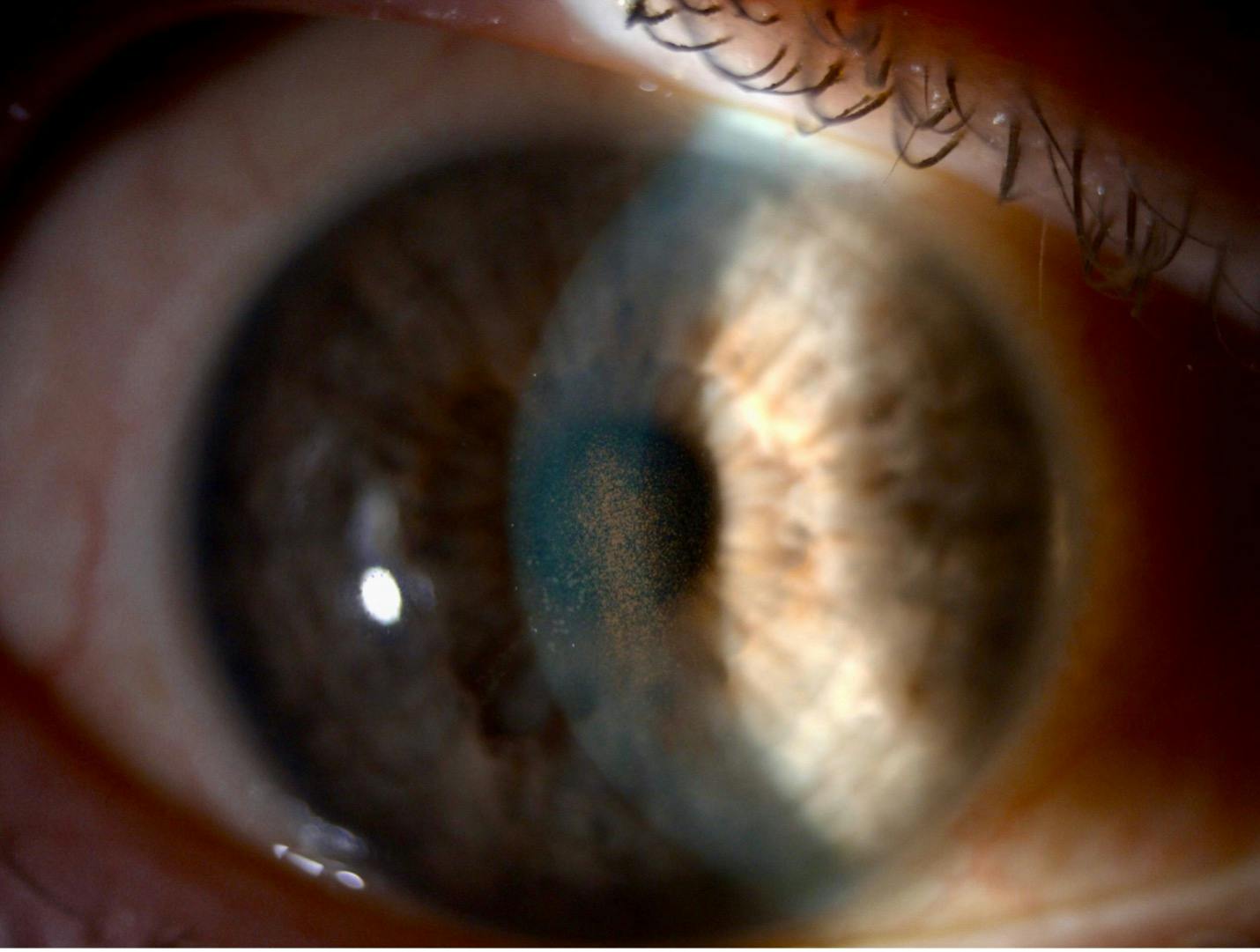 Early IOP Spike Post Cataract Surgery? - Modern Optometry