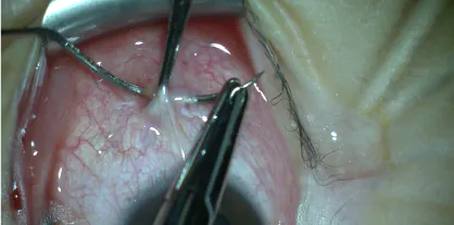 A Peritomy-Sparing Approach for Scleral Buckle in Pediatric RRD ...