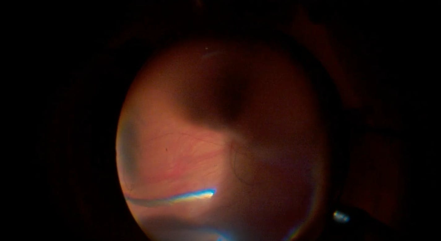 IOL Repositioning With Sutureless Intrascleral Fixation - Eyetube