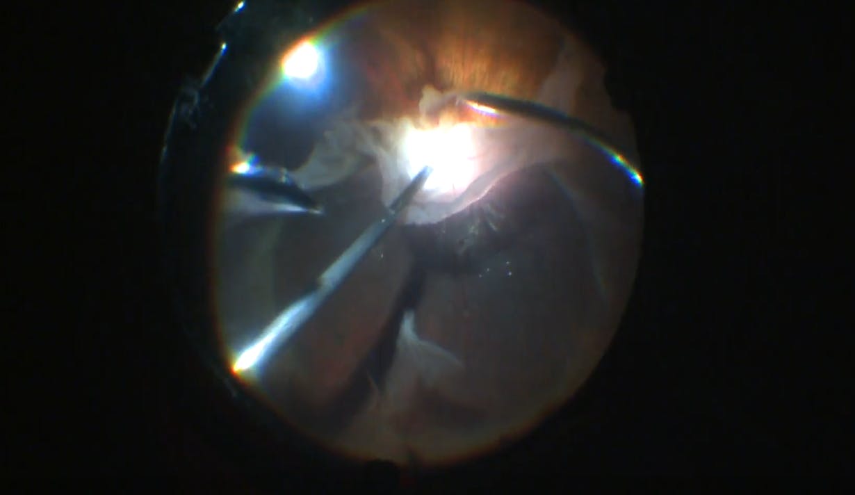 Giant Retinal Tear With Narrow Funnel Configuration - Eyetube