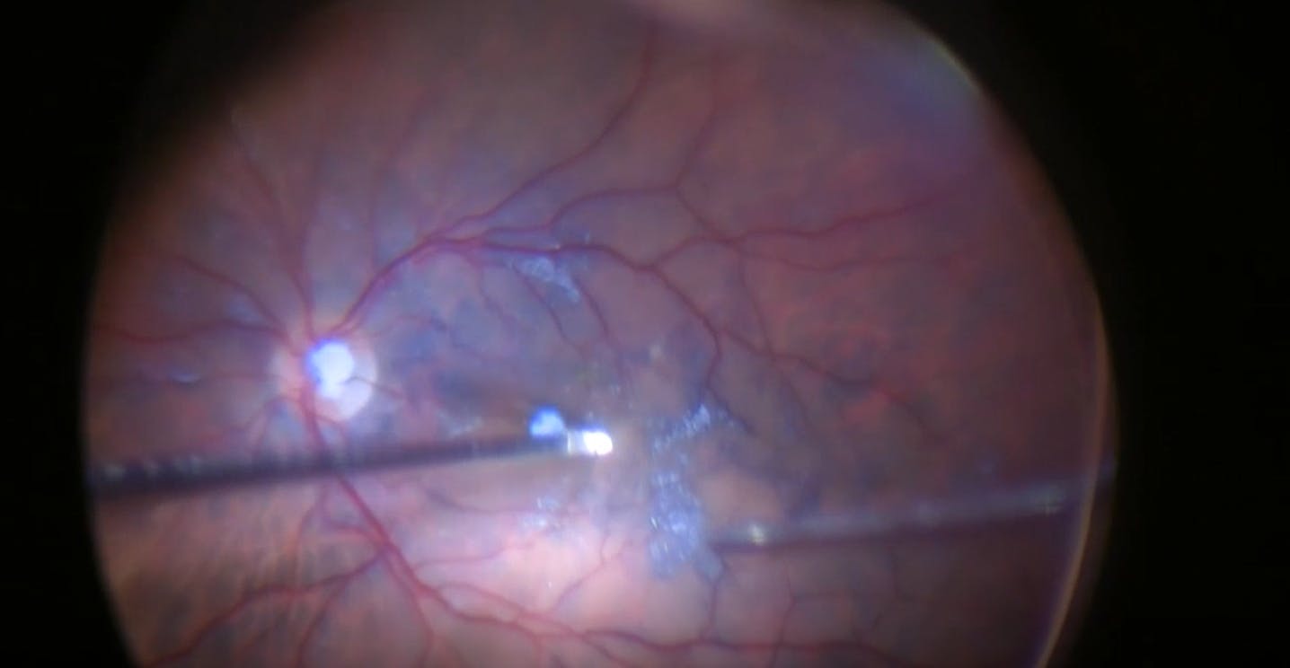 Complete Vitrectomy and ILM Peeling - Eyetube