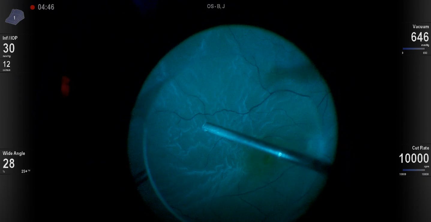 Epiretinal Membrane Peel Under PFO - Eyetube