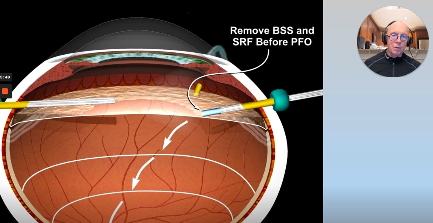 Medium-Term PFO for Inferior Retinal Detachments and Giant Retinal ...