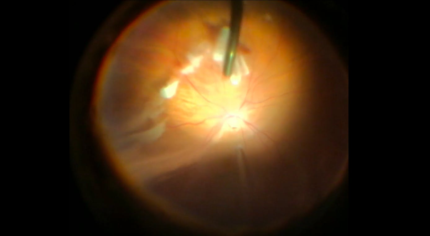 Hypersonic Vitrectomy for Macular Hole - Eyetube