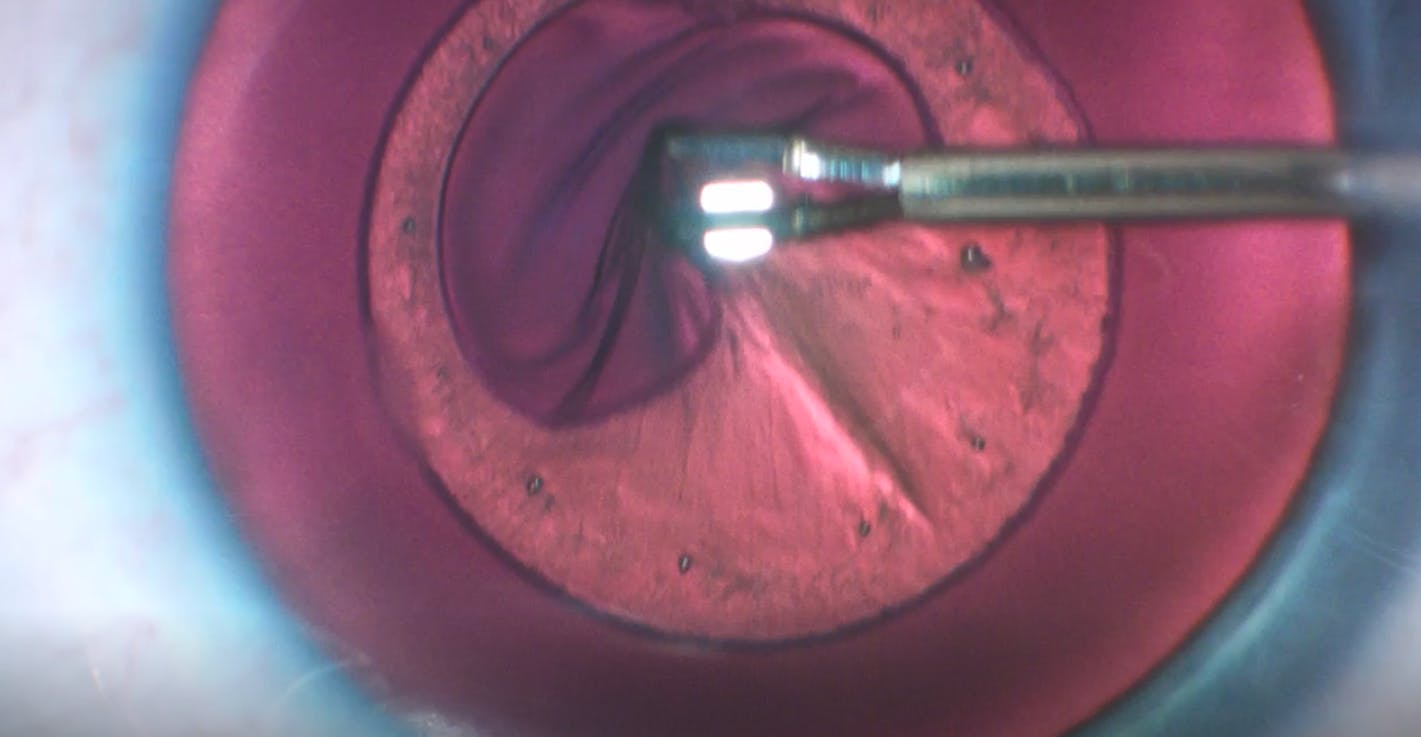 CapsuLaser Technique for Capsulorhexis Creation - Eyetube