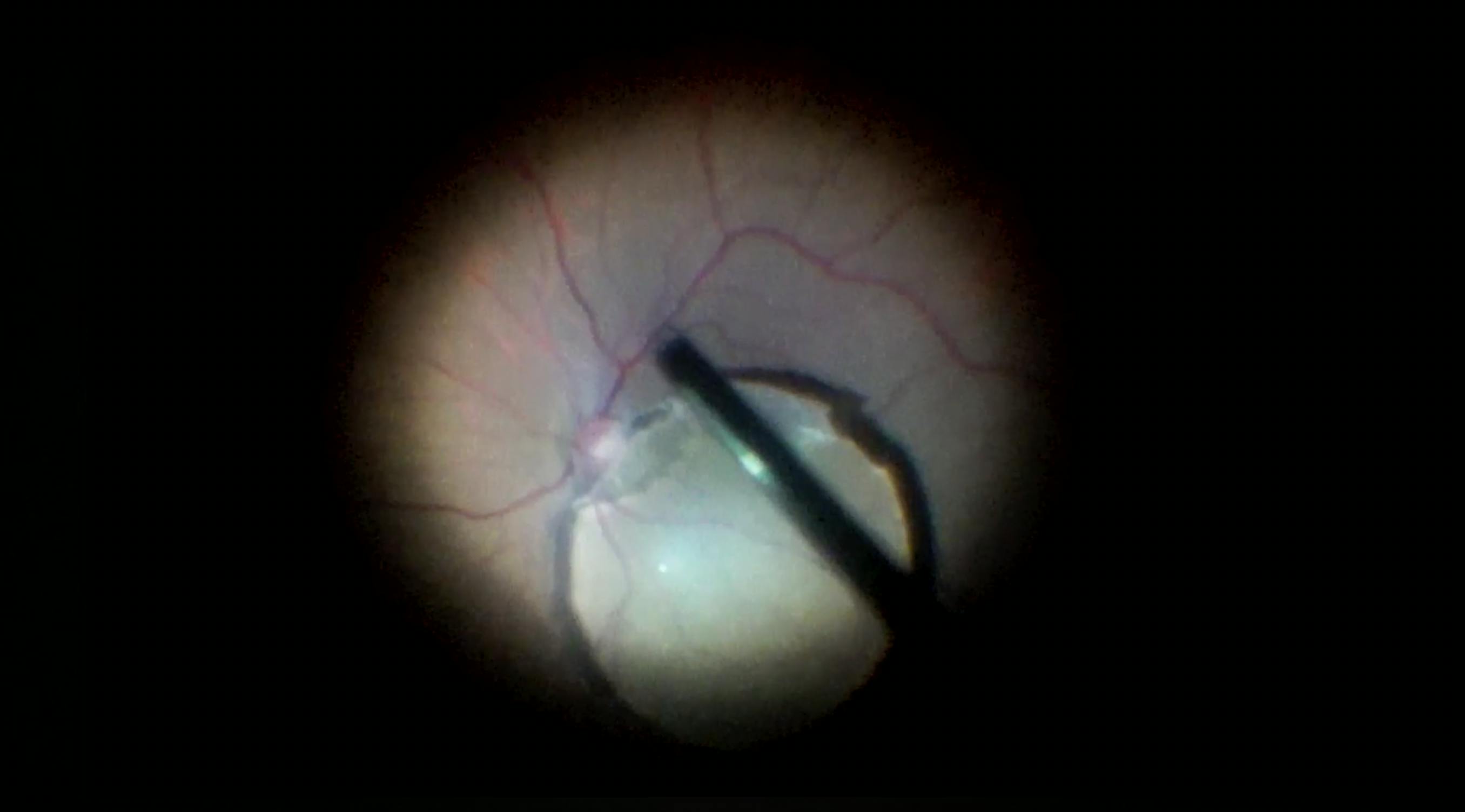 Dislocated Lens and Secondary Retinal Detachment - Eyetube