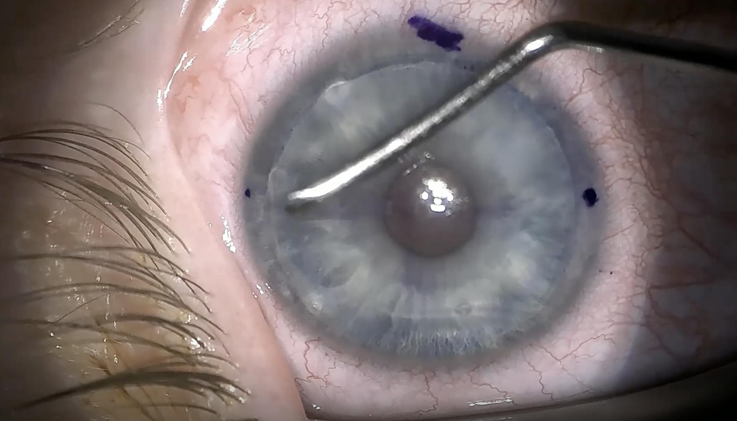 Lenticle Intrastromal Keratoplasty (LIKE) - Eyetube