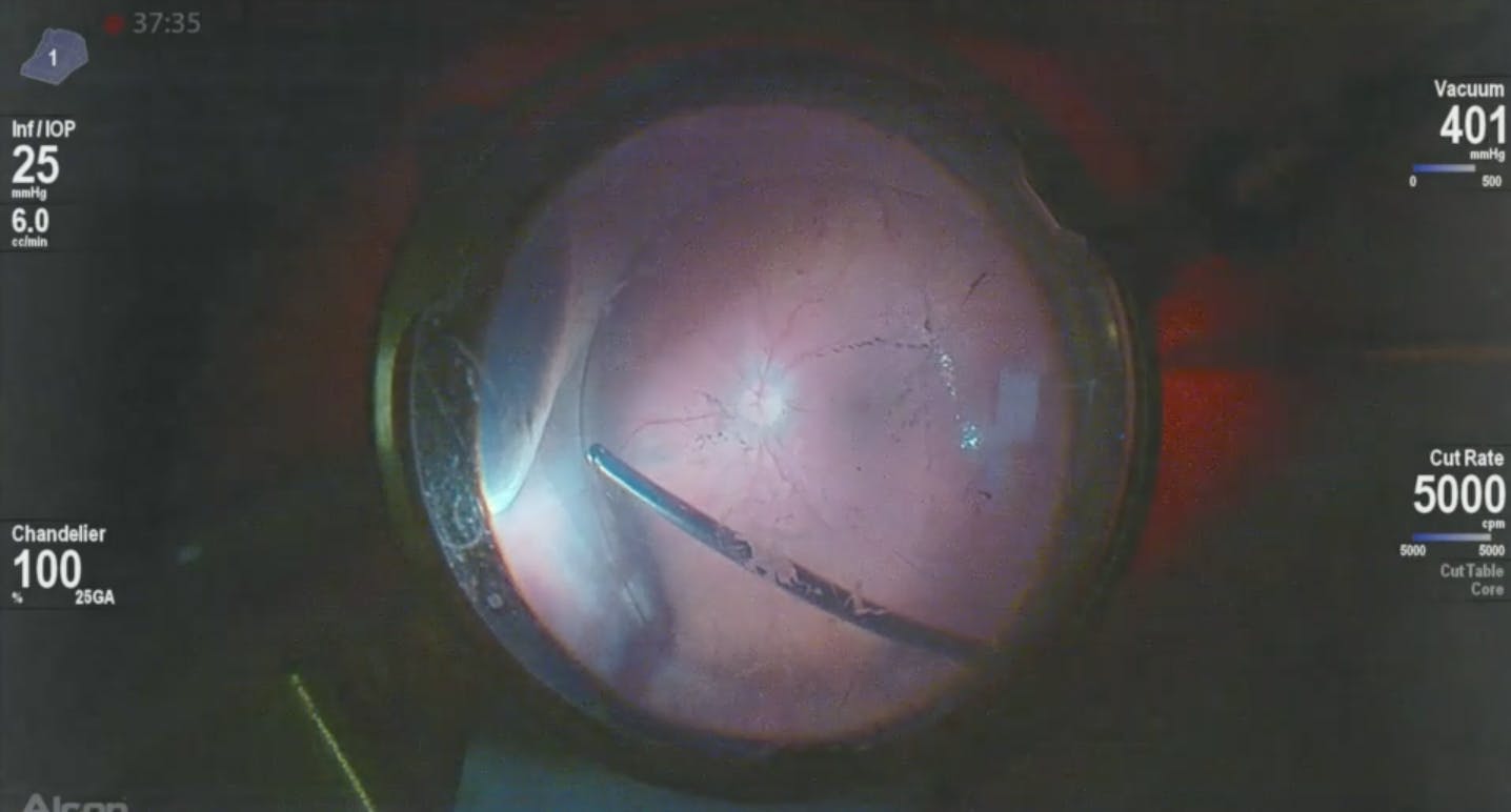 Pediatric Retinal Detachment - Eyetube